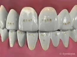 Brown spots on teeth: What are they and how do you treat them ...